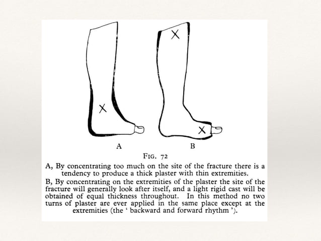 Plaster of paris in orthopaedics | PPSX