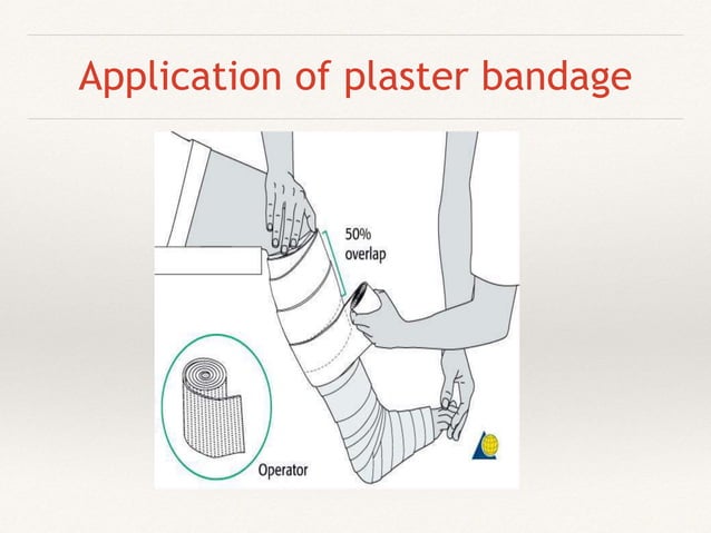 Plaster of paris in orthopaedics | PPSX