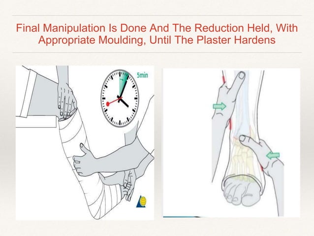 Plaster of paris in orthopaedics | PPSX