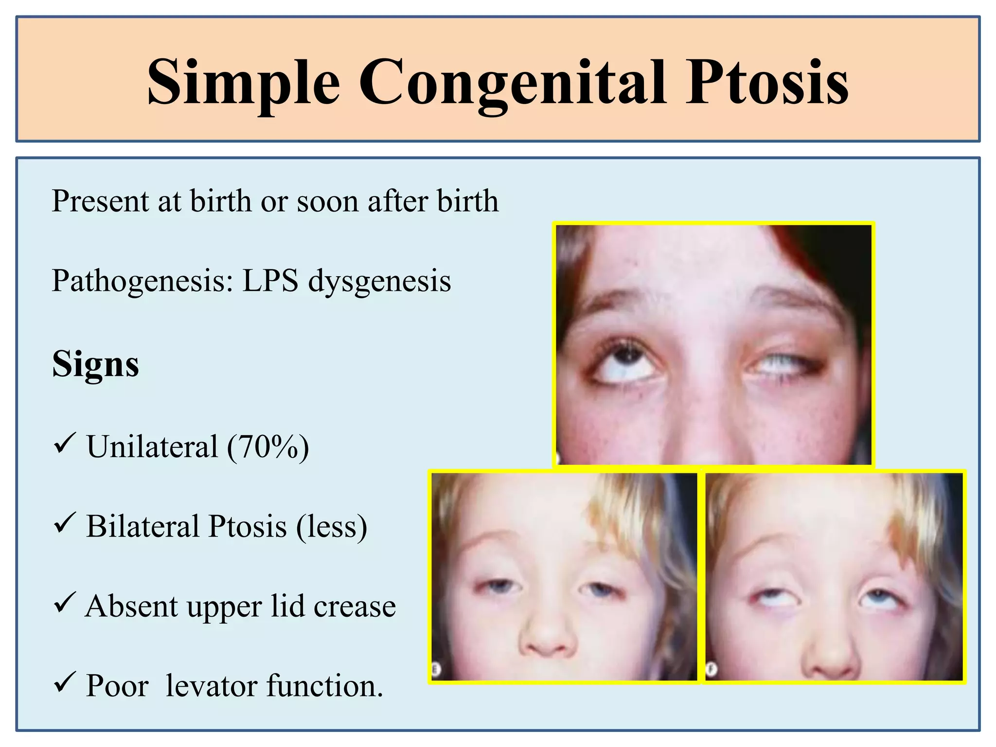 Real ptosis evaluation.pptx