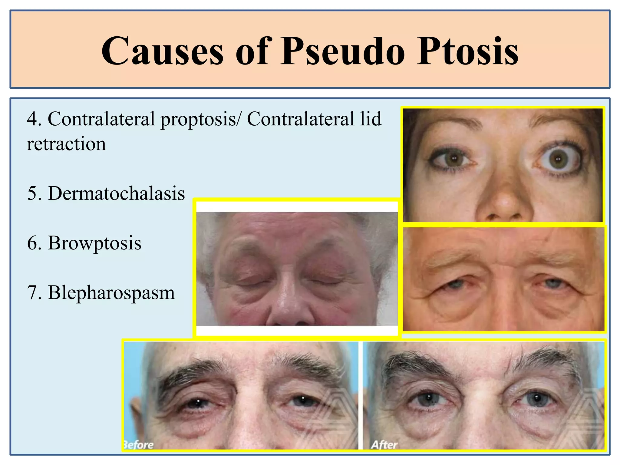 Real ptosis evaluation.pptx