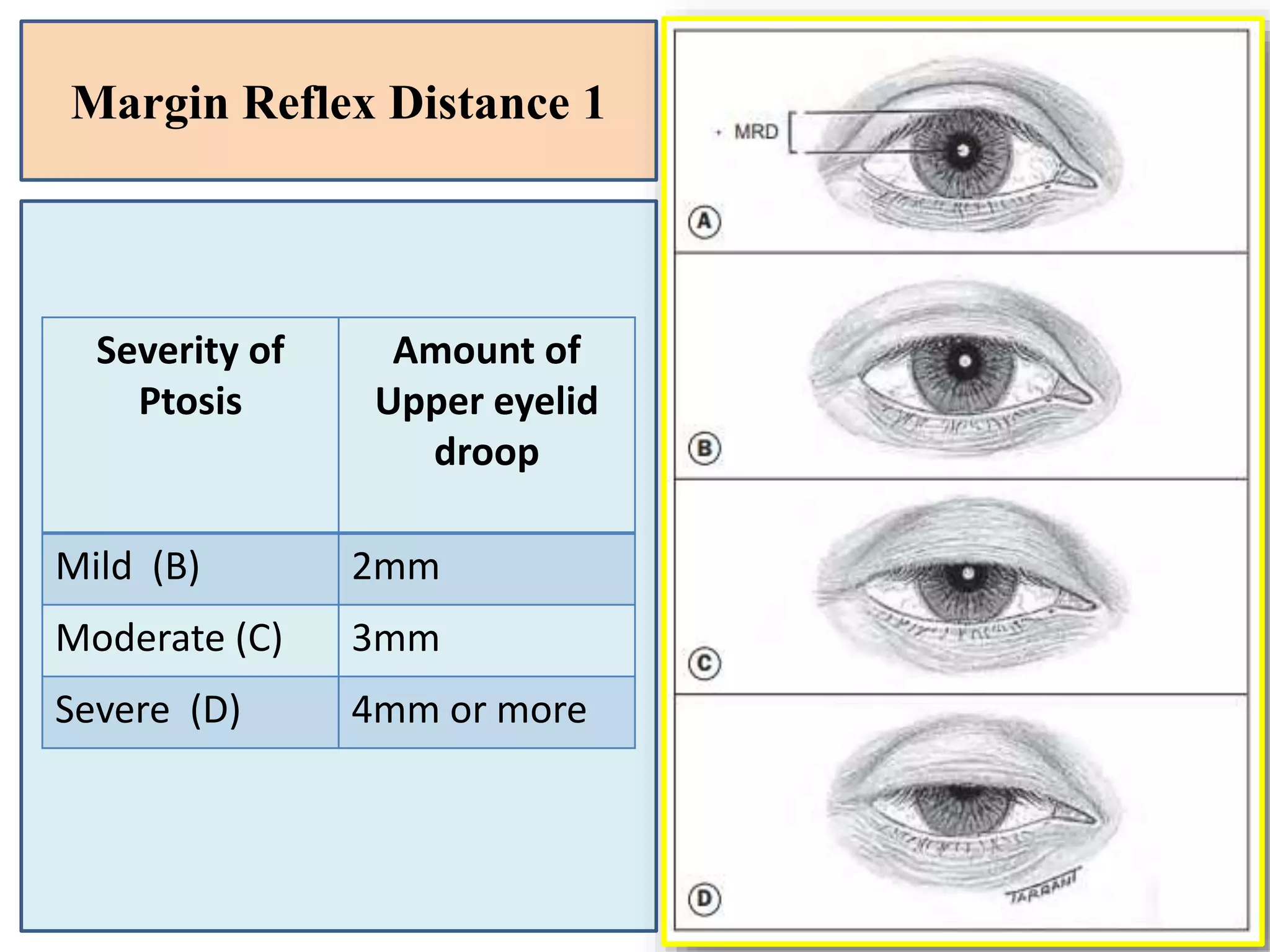 Real ptosis evaluation.pptx