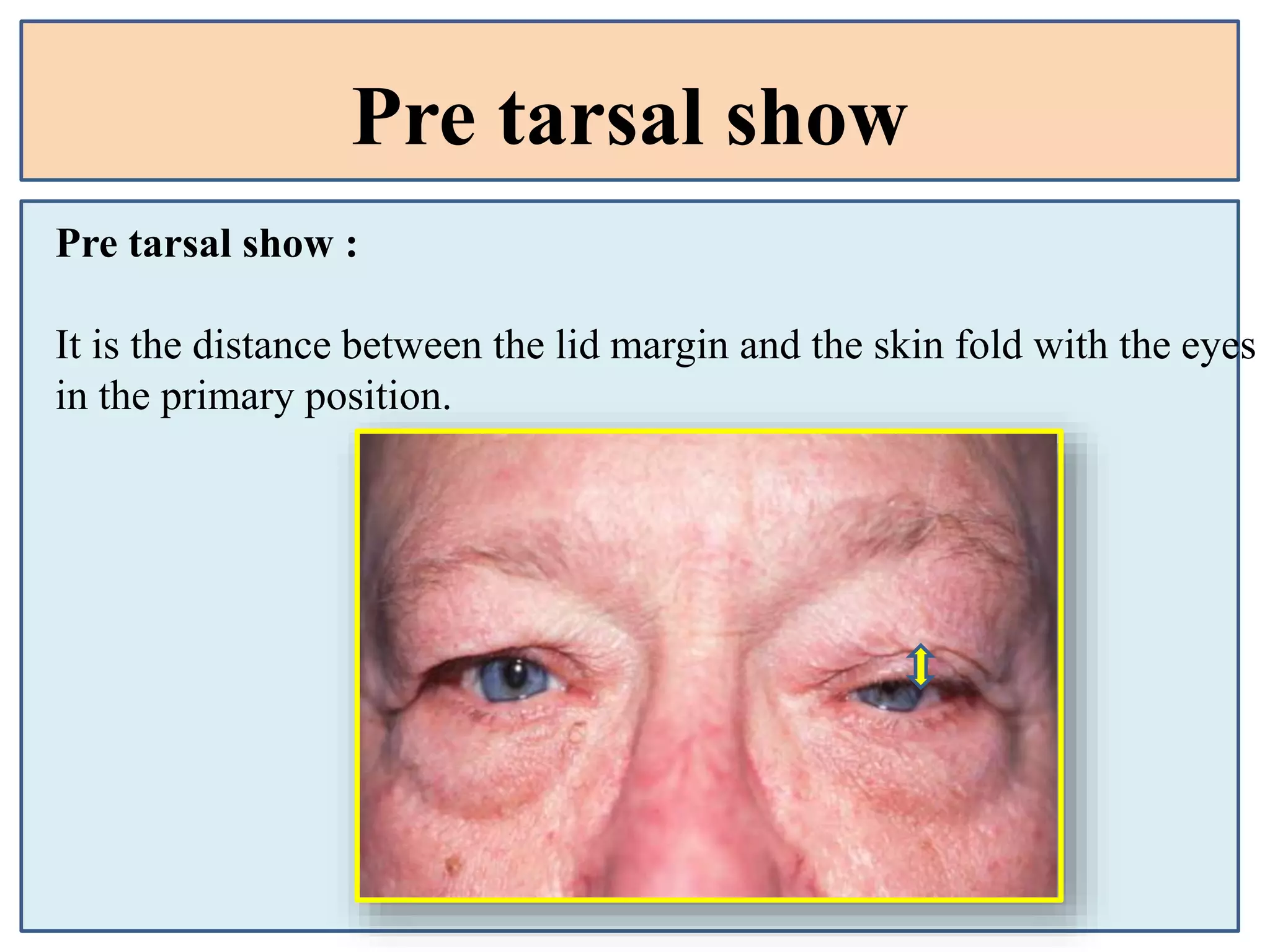 Real ptosis evaluation.pptx