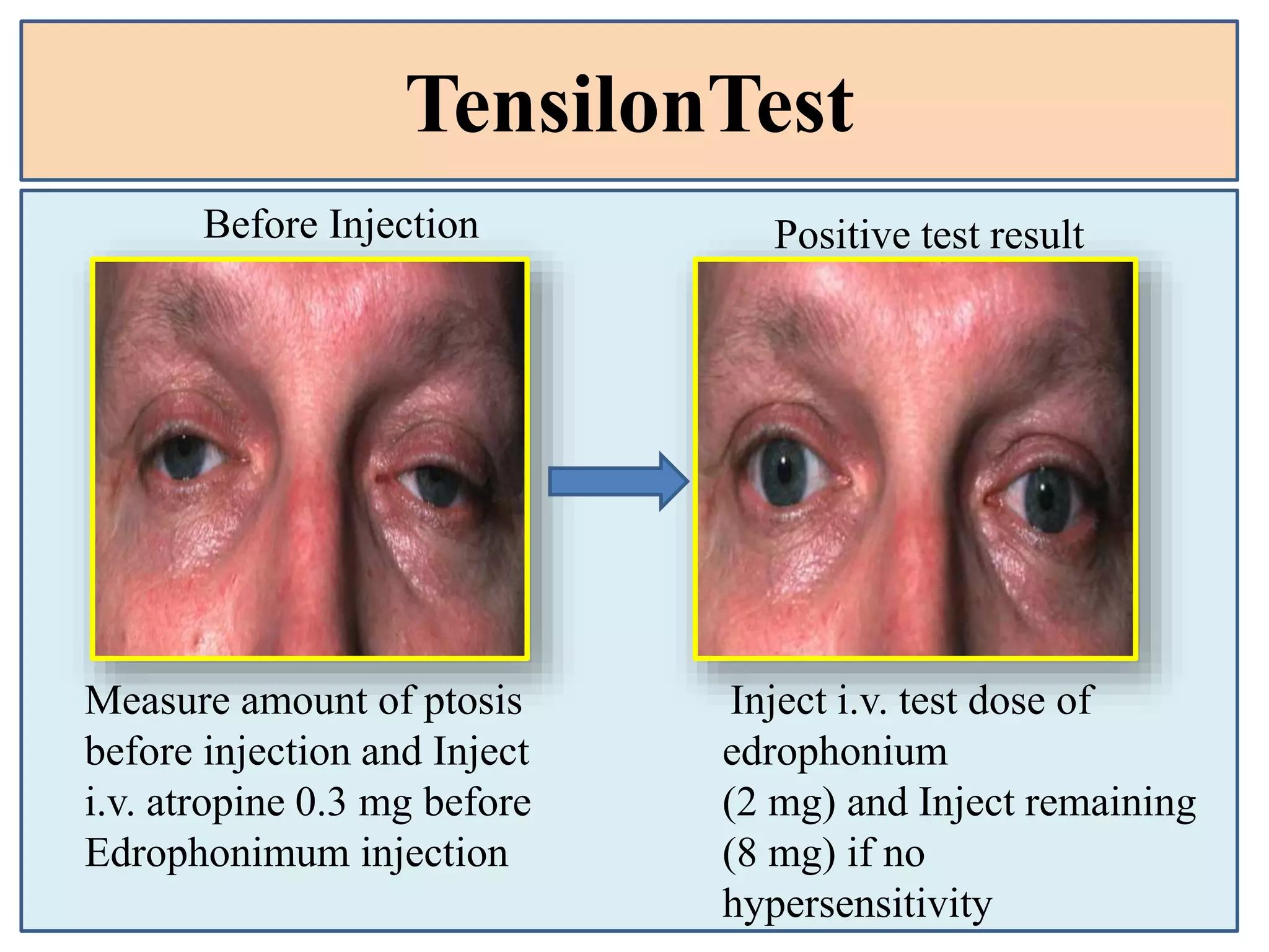 Real ptosis evaluation.pptx