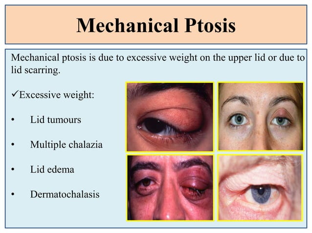Real ptosis evaluation.pptx | Eye and Vision Conditions | Diseases and ...