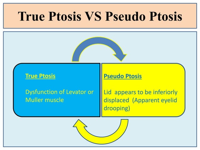 Real ptosis evaluation.pptx | Eye and Vision Conditions | Diseases and ...