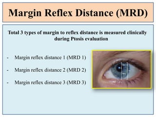 Real ptosis evaluation.pptx