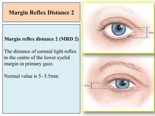 Real ptosis evaluation.pptx