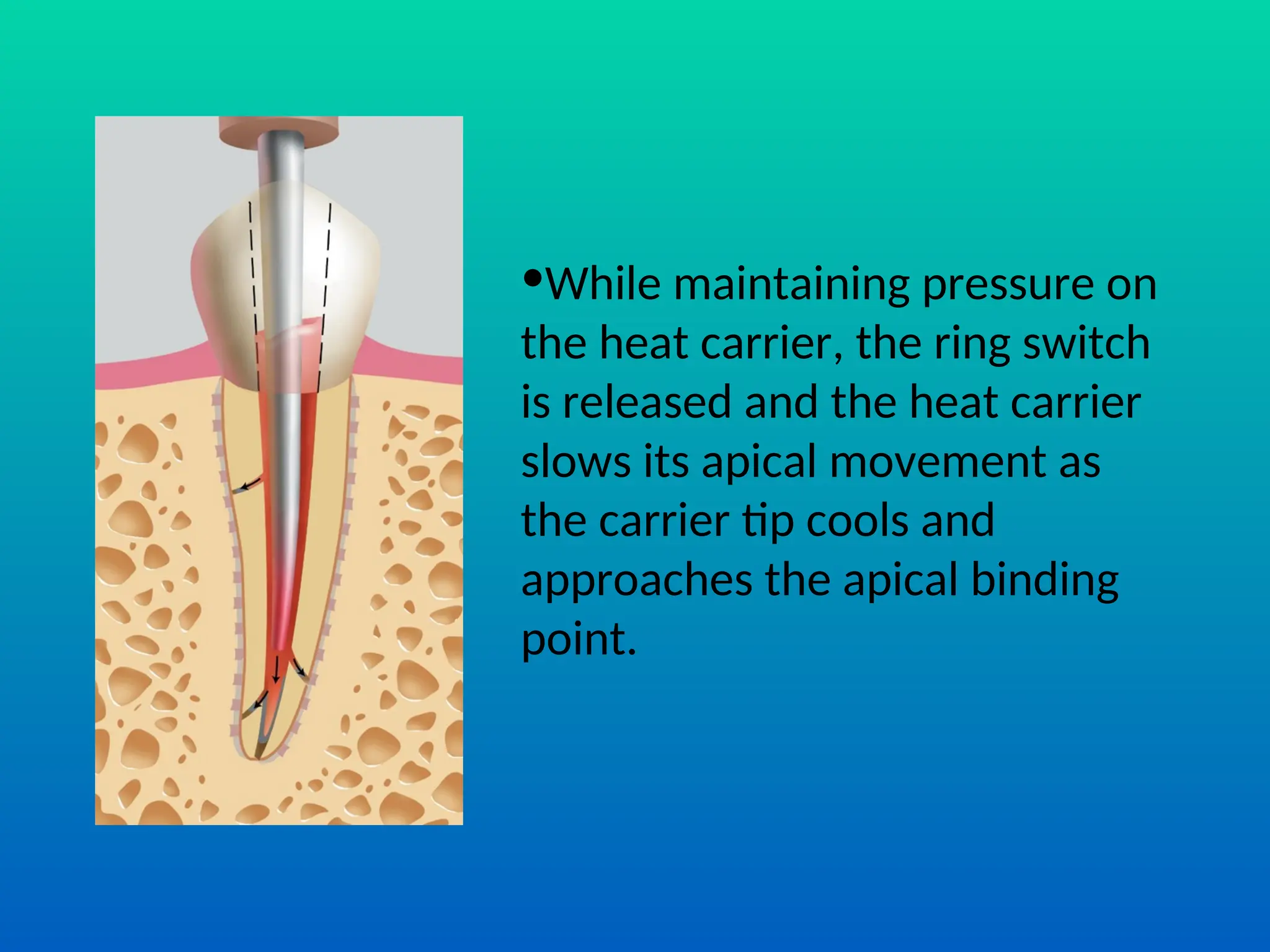 Root Filling Material: RealSeal (Resilon).ppt