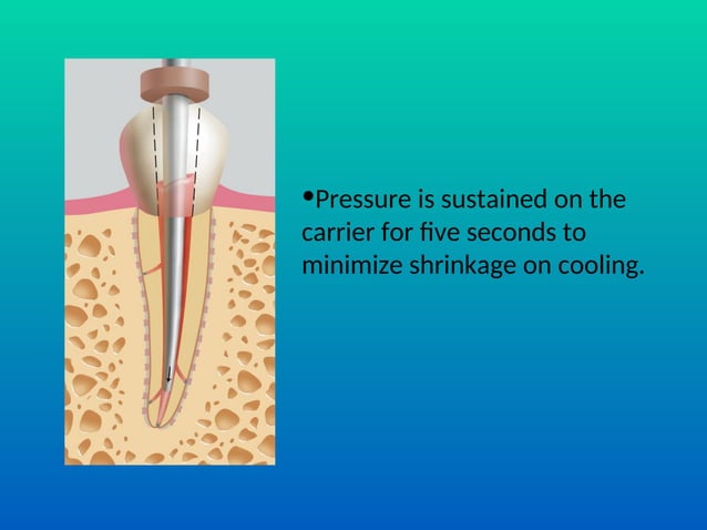 Root Filling Material: RealSeal (Resilon).ppt