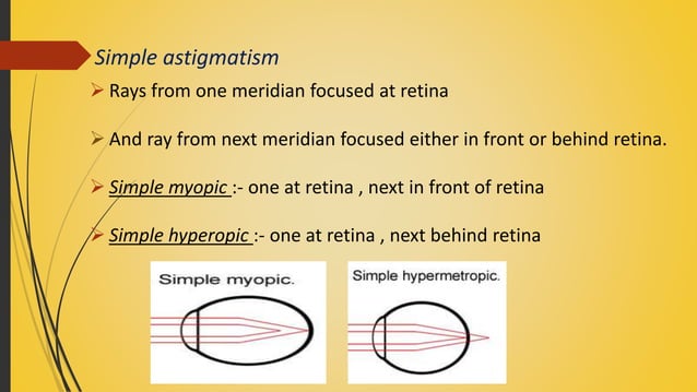 Real subjective refraction in astigmatism | PPTX