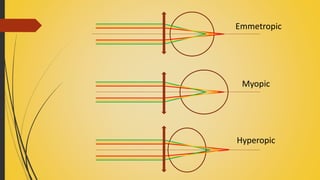 Real subjective refraction in astigmatism | PPTX