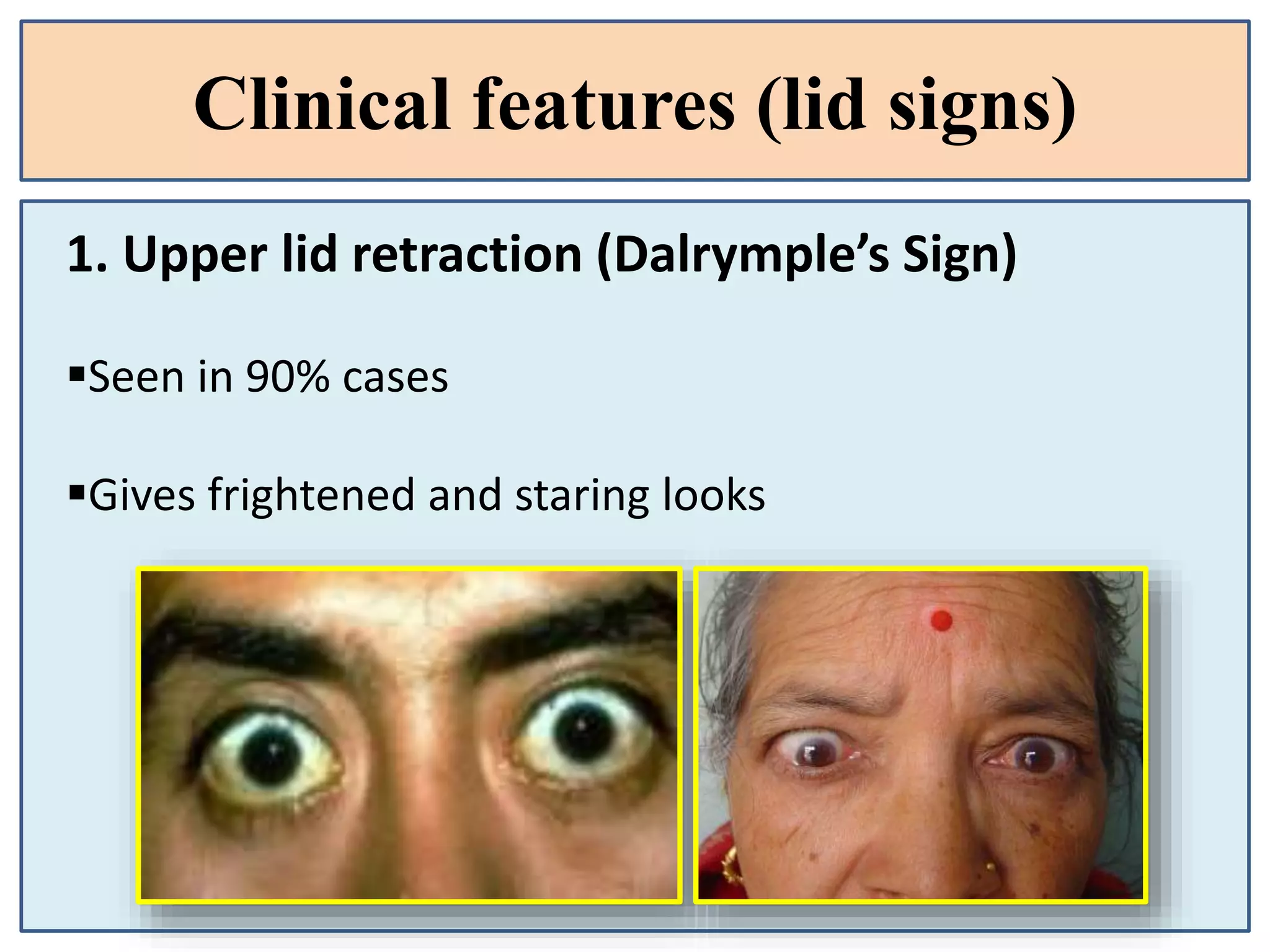 REAL THYROID OPHTHALMOPATHY.pptx