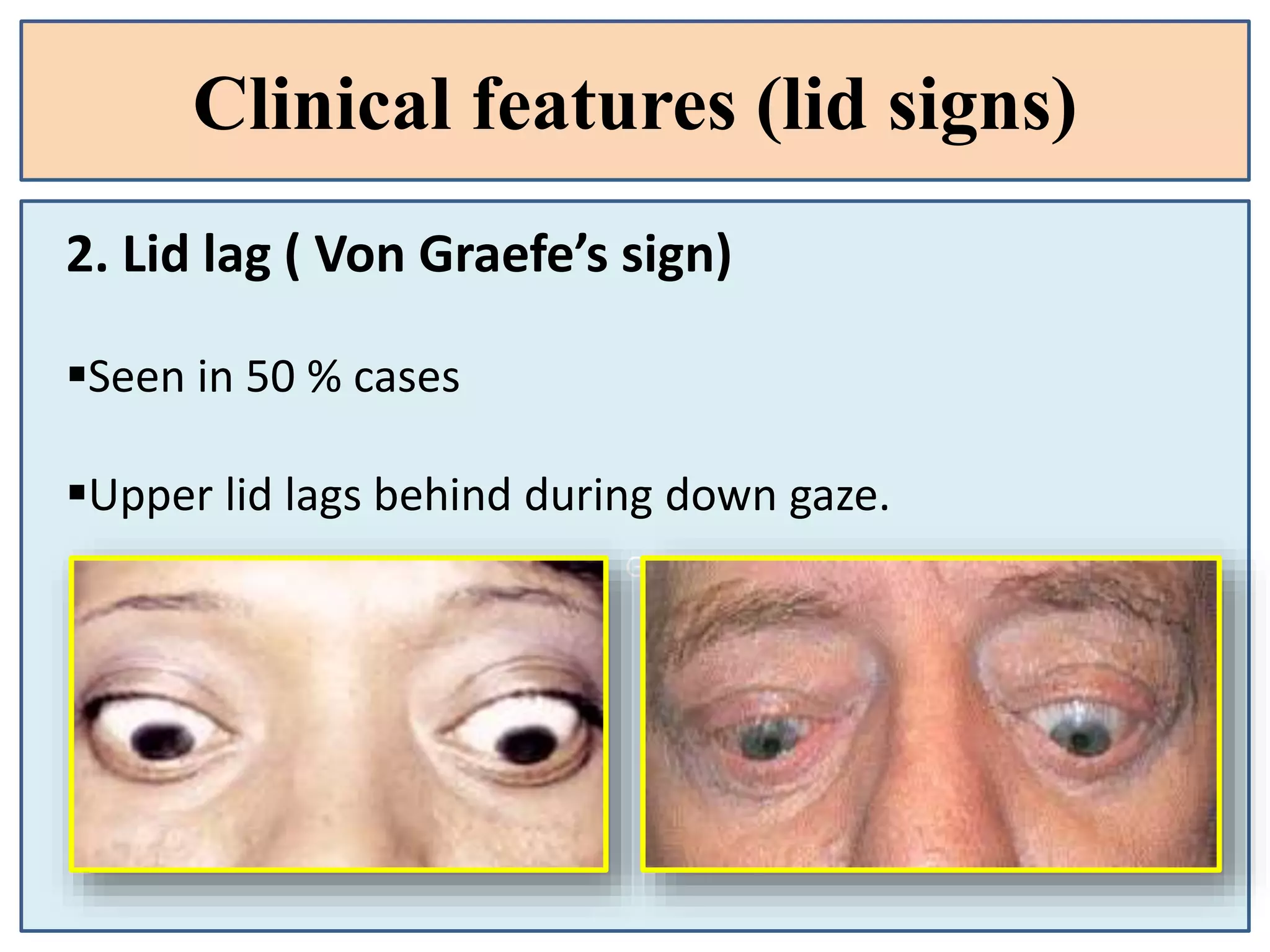 REAL THYROID OPHTHALMOPATHY.pptx