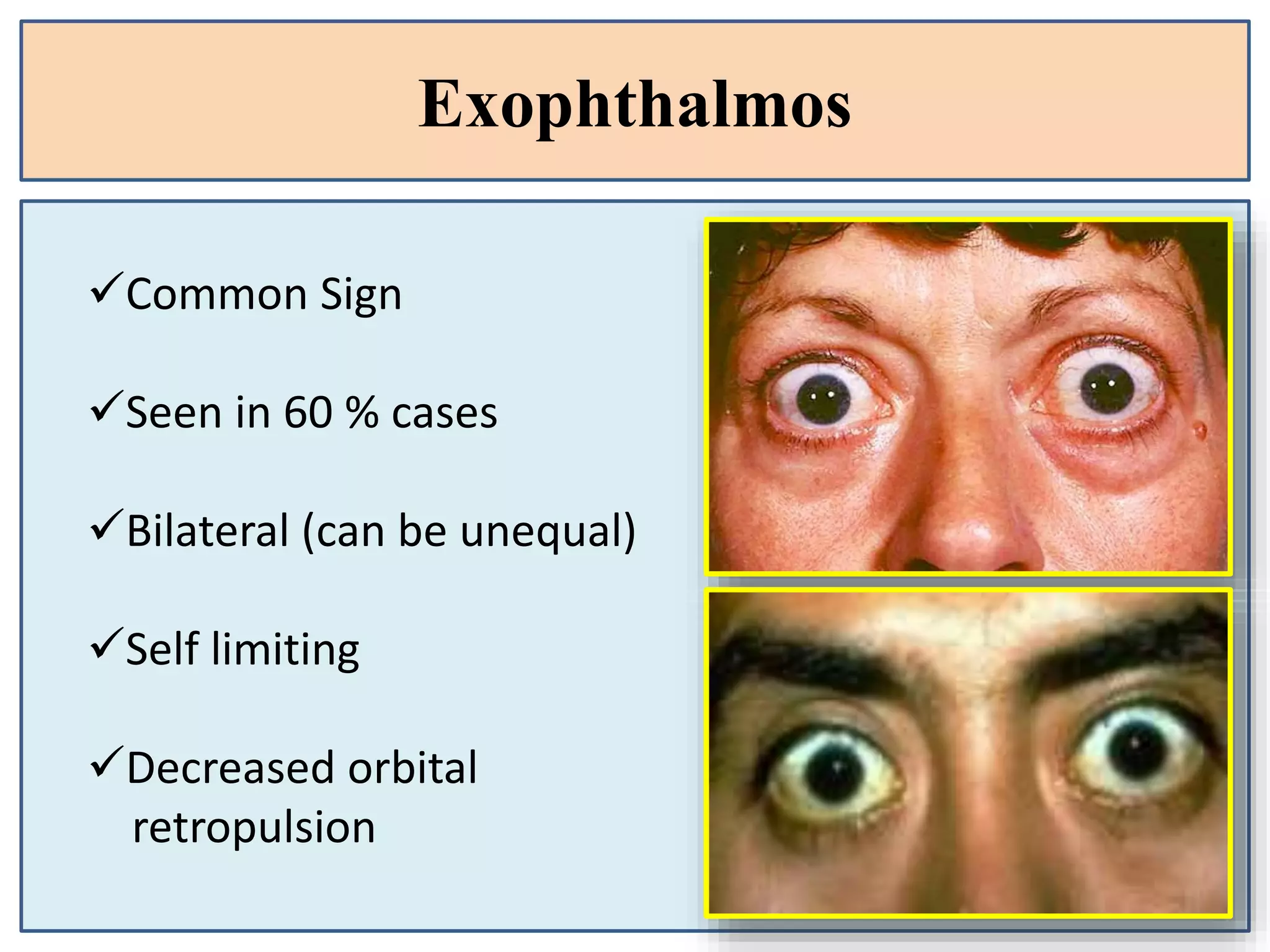 REAL THYROID OPHTHALMOPATHY.pptx
