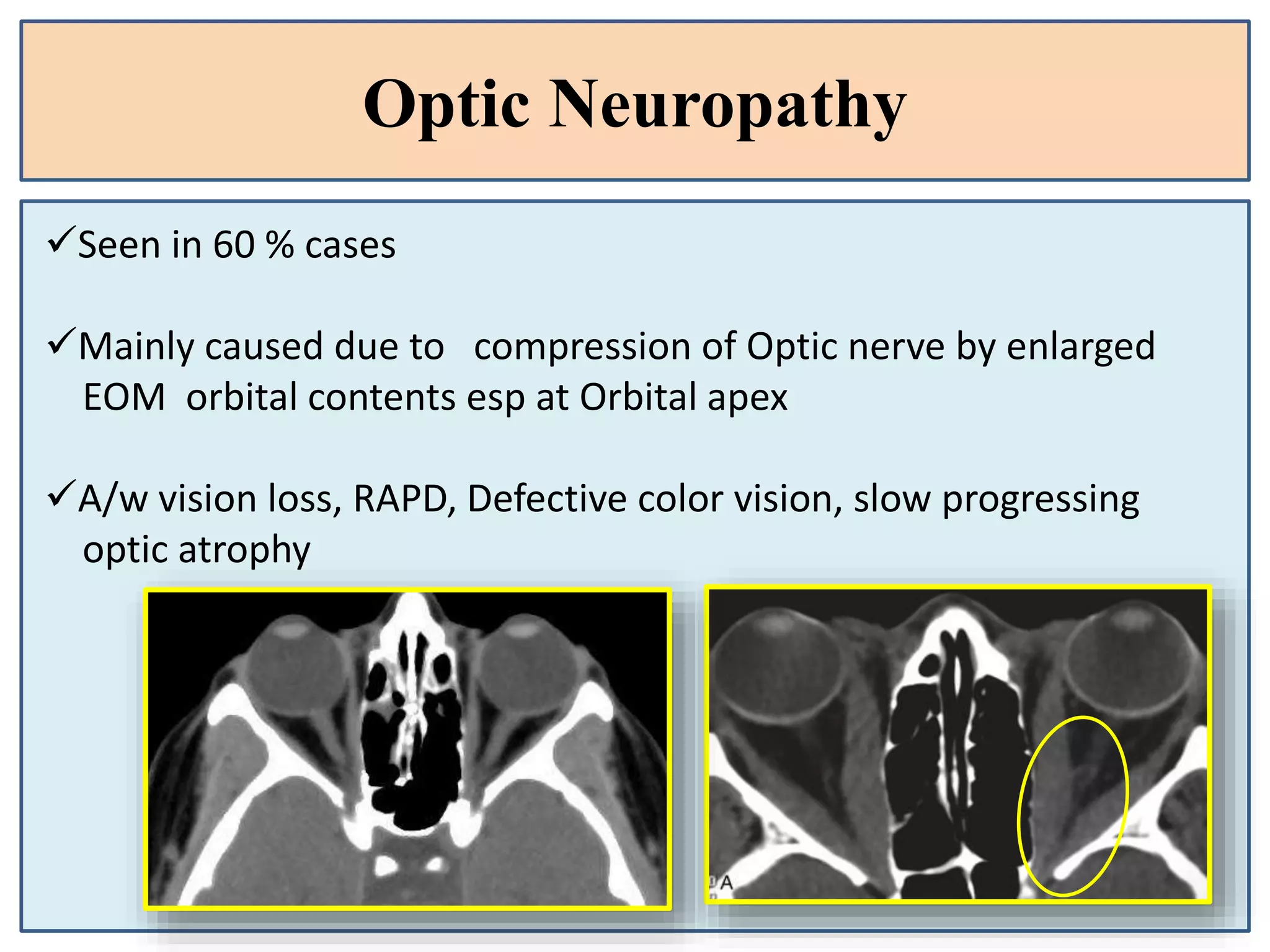 REAL THYROID OPHTHALMOPATHY.pptx