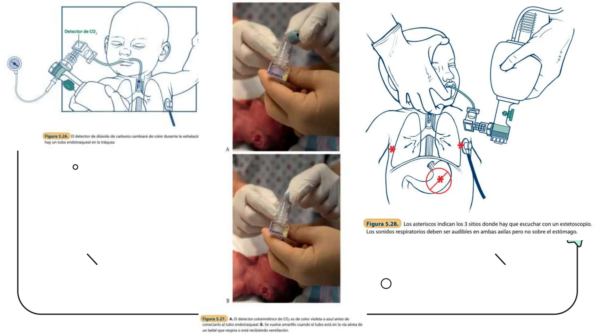 Reanimación neonatal PEDIATRIA, AMERICAN HEART ASSOCIATION .pptx