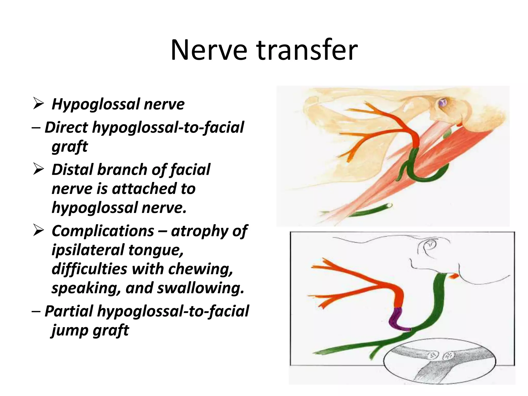 Reanimation of facial paralysis | PPTX