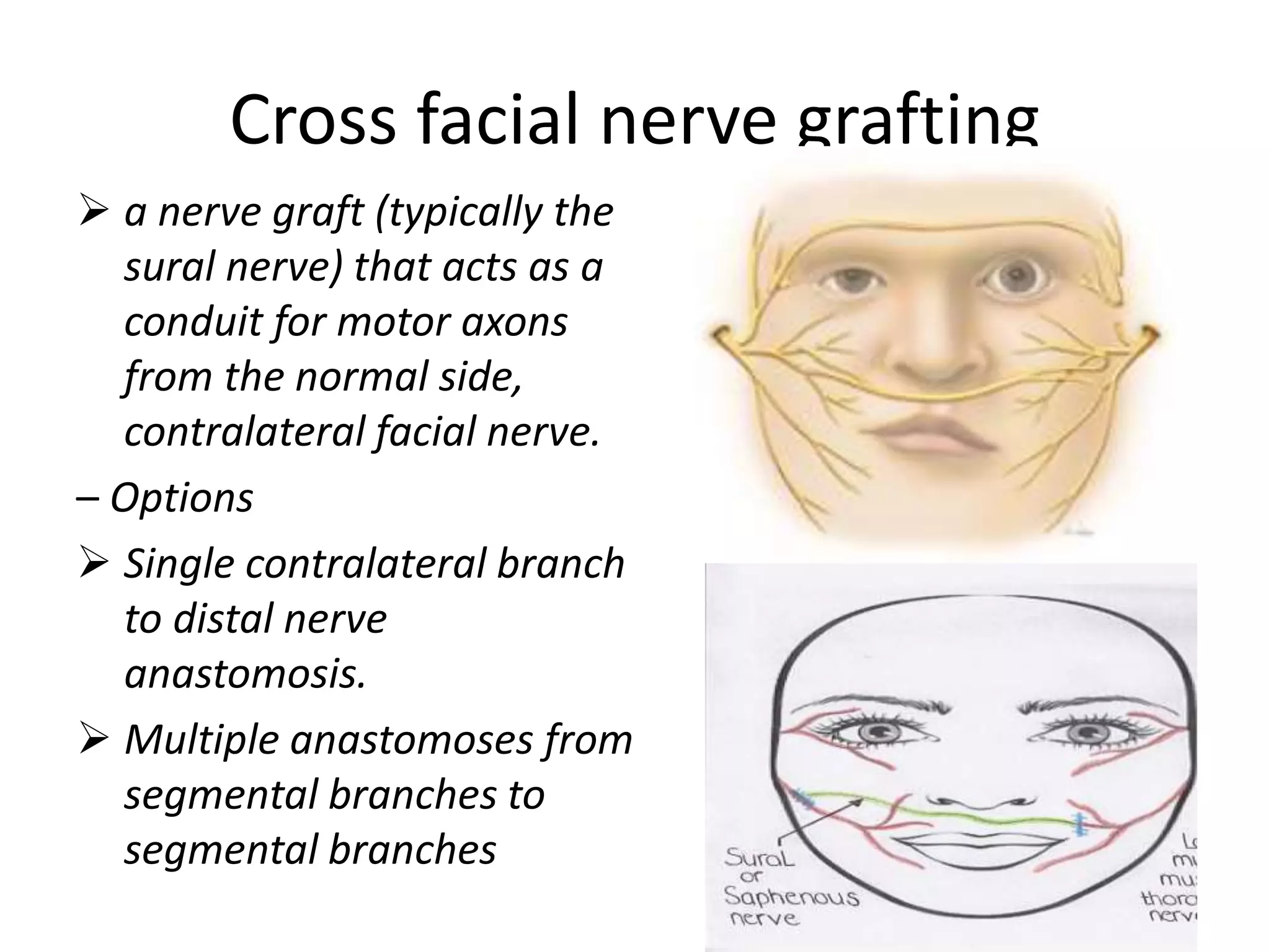 Reanimation of facial paralysis | PPTX