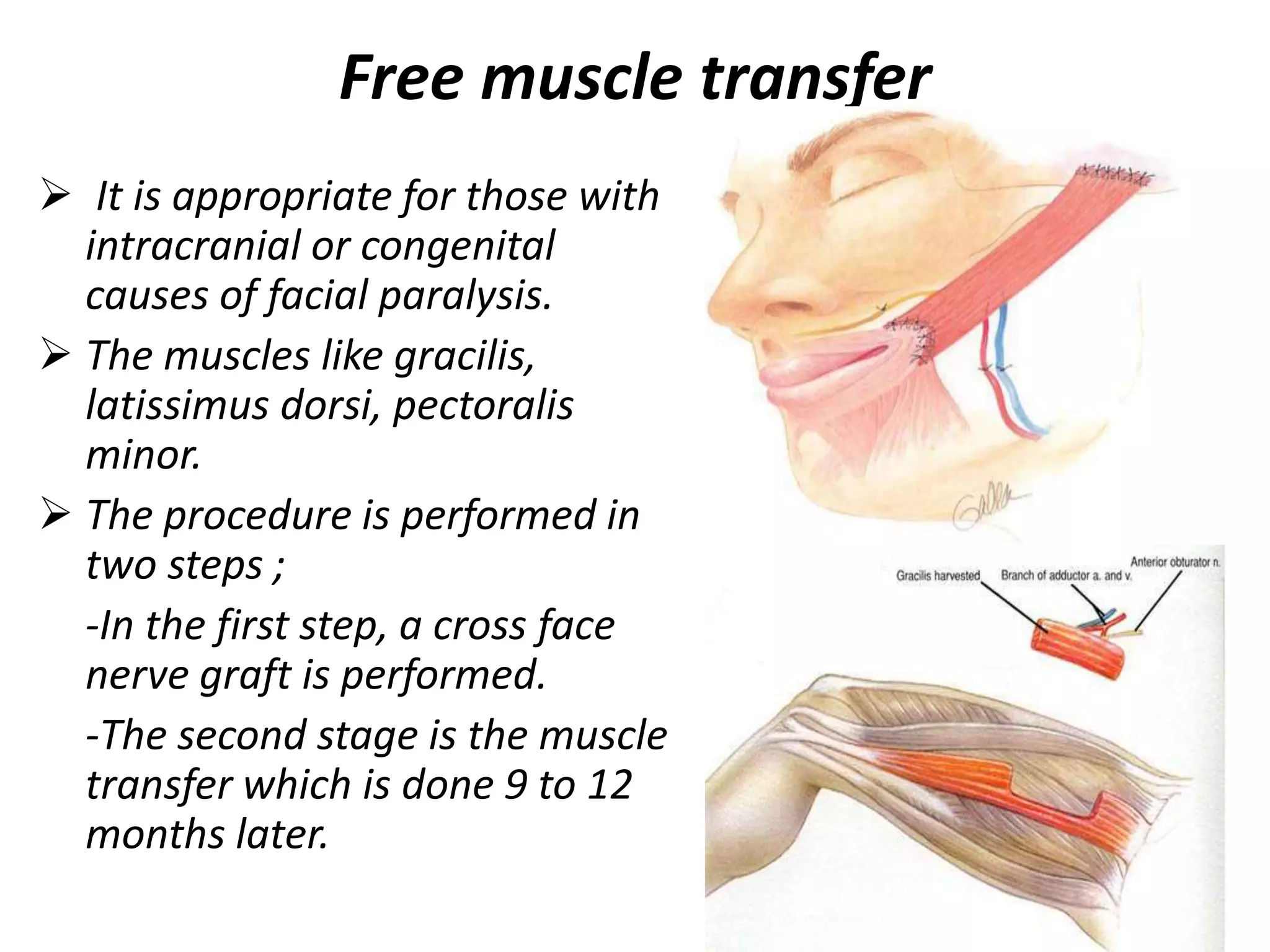 Reanimation of facial paralysis | PPTX