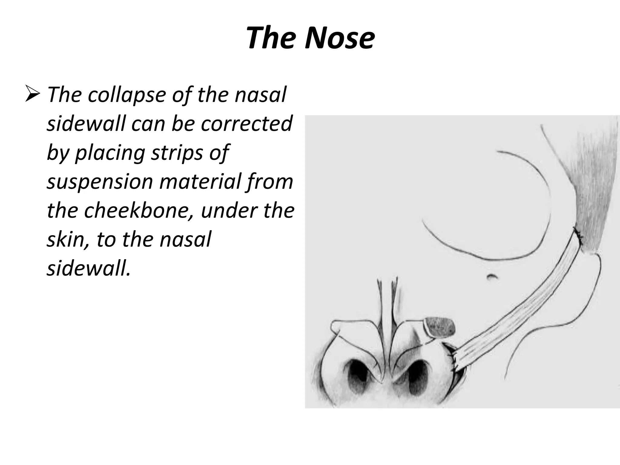 Reanimation of facial paralysis | PPTX