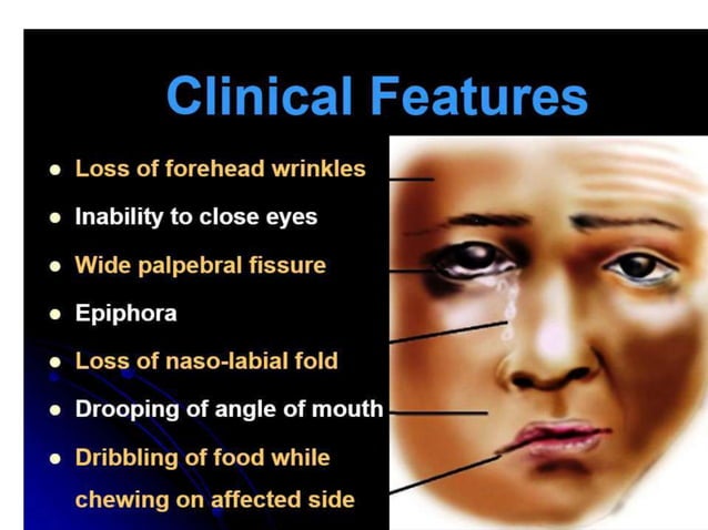 Reanimation of facial paralysis | PPTX