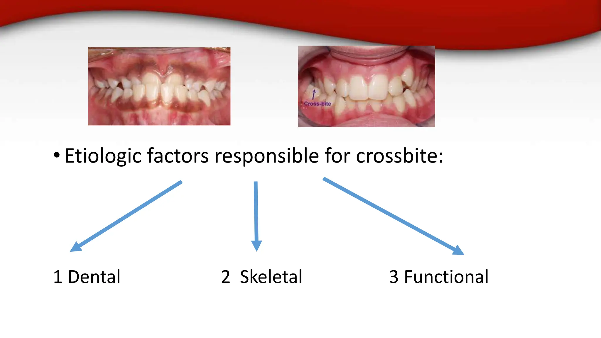 Reason And Periods For Treatment For Posterior Crossbite.pptx | Dental ...