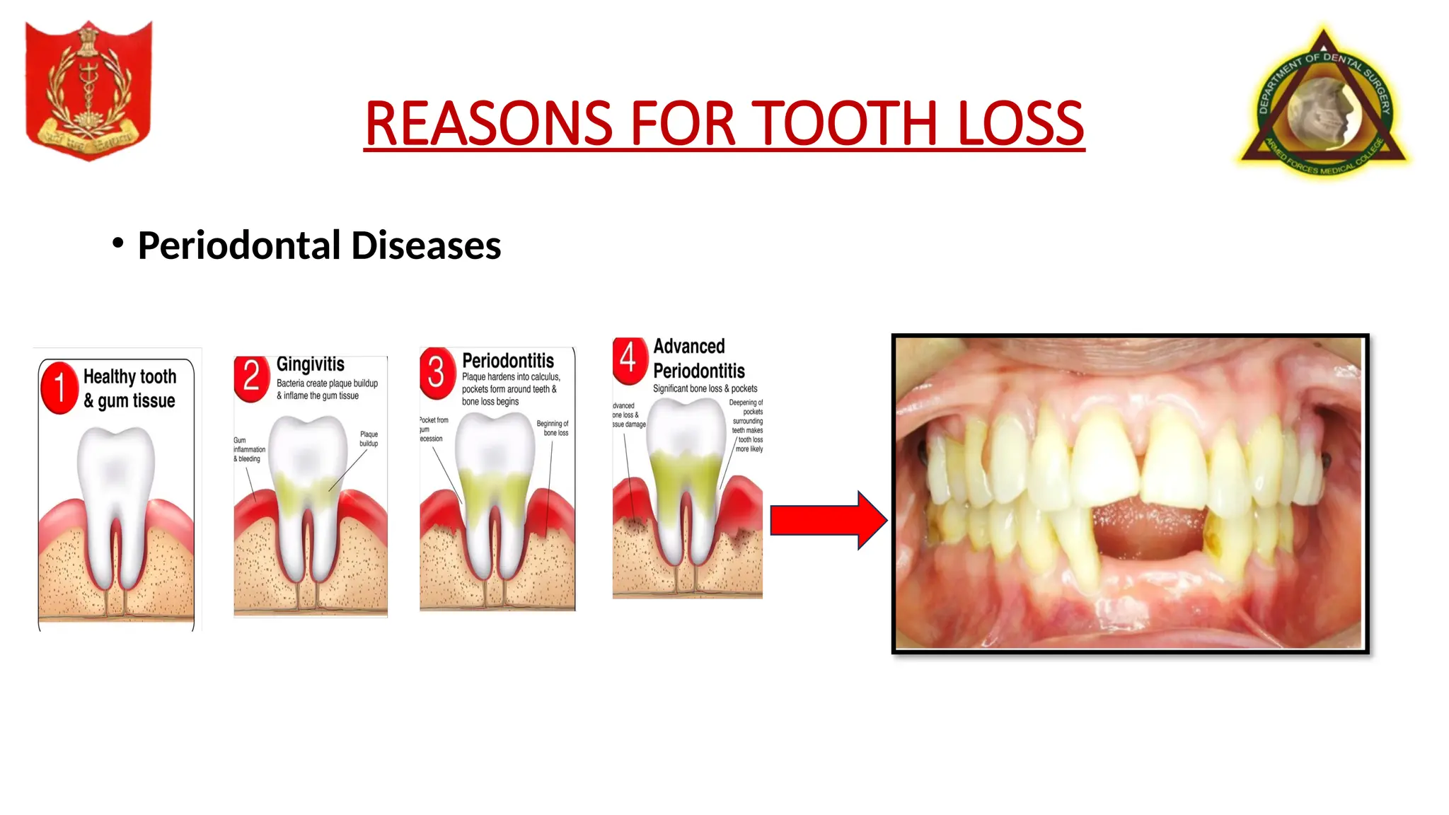 paper presentation reasons for tooth loss.pptx