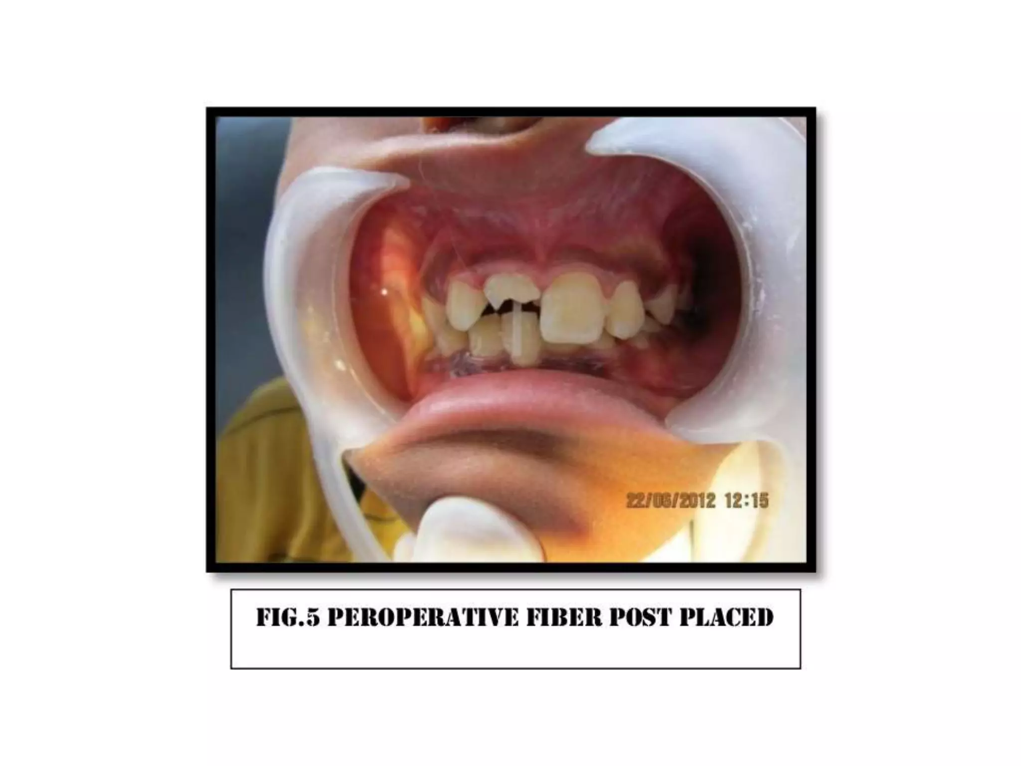 Reatthachemnt of fractured central incisor | PPTX