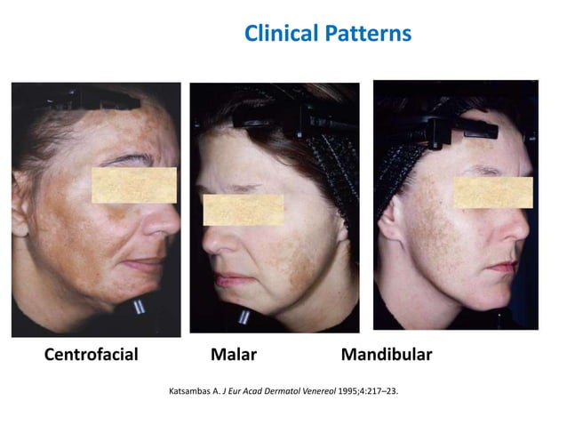 RECALCITRANT MELASMA IN DERMATOLOGY TREATMENT | PPT | Skin and ...