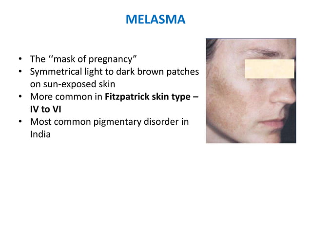 RECALCITRANT MELASMA IN DERMATOLOGY TREATMENT | PPT | Skin and ...