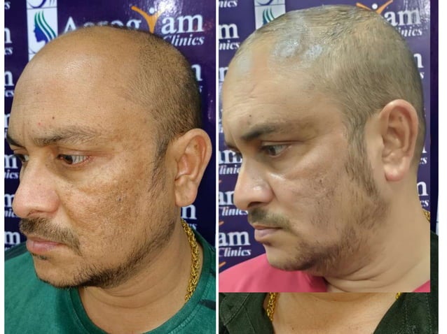 RECALCITRANT MELASMA IN DERMATOLOGY TREATMENT | PPT | Skin and ...