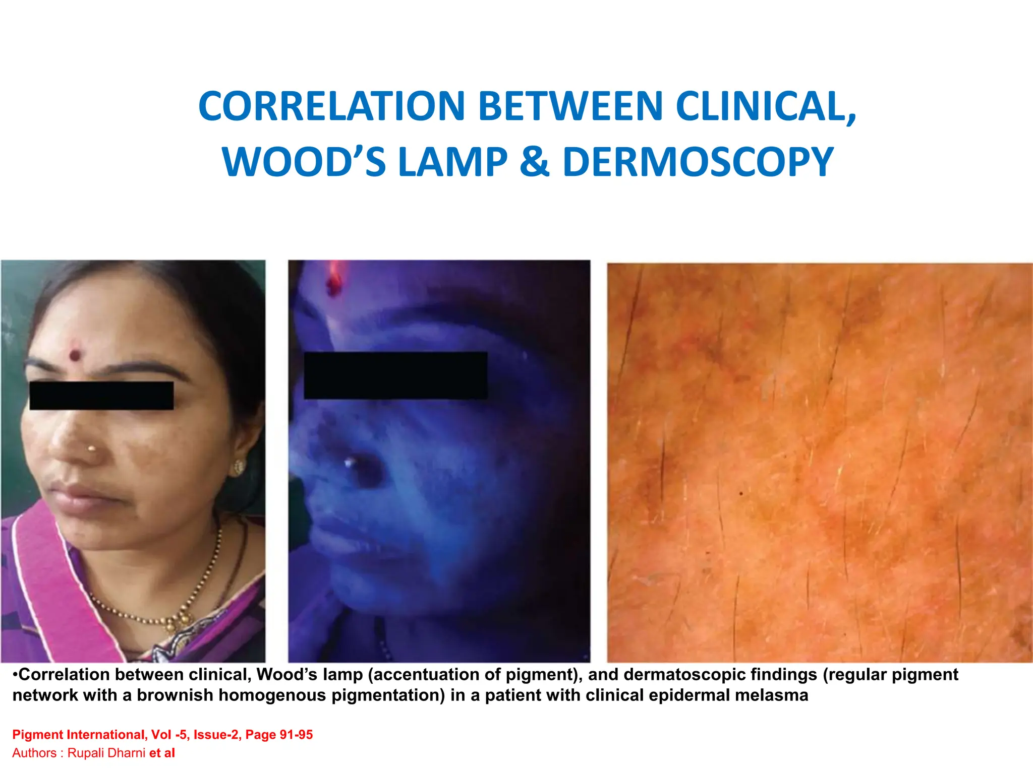 RECALCITRANT MELASMA IN DERMATOLOGY TREATMENT | PPT