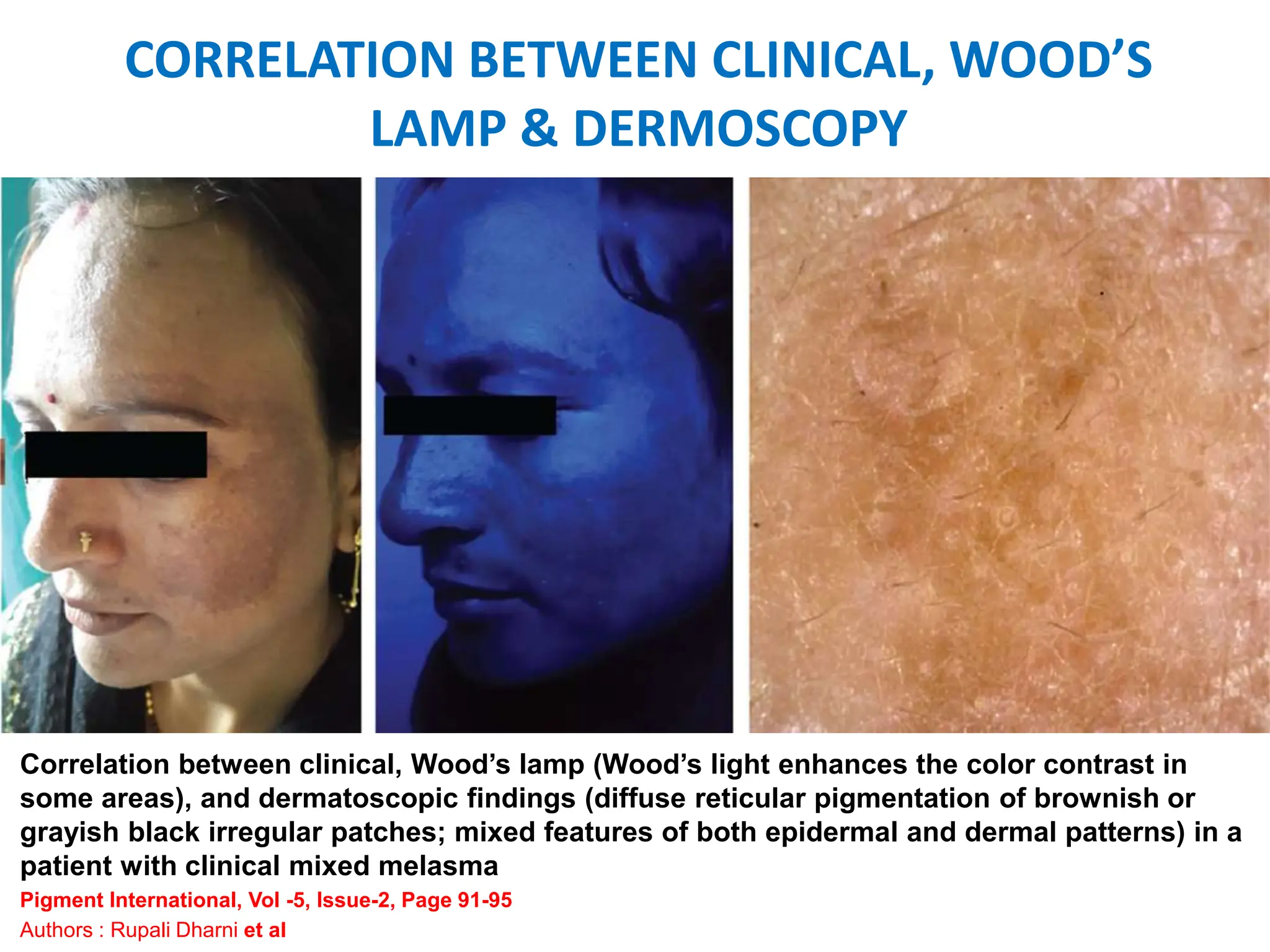 RECALCITRANT MELASMA IN DERMATOLOGY TREATMENT | PPT