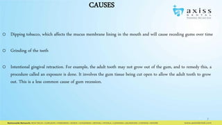 Receding gums | PPT