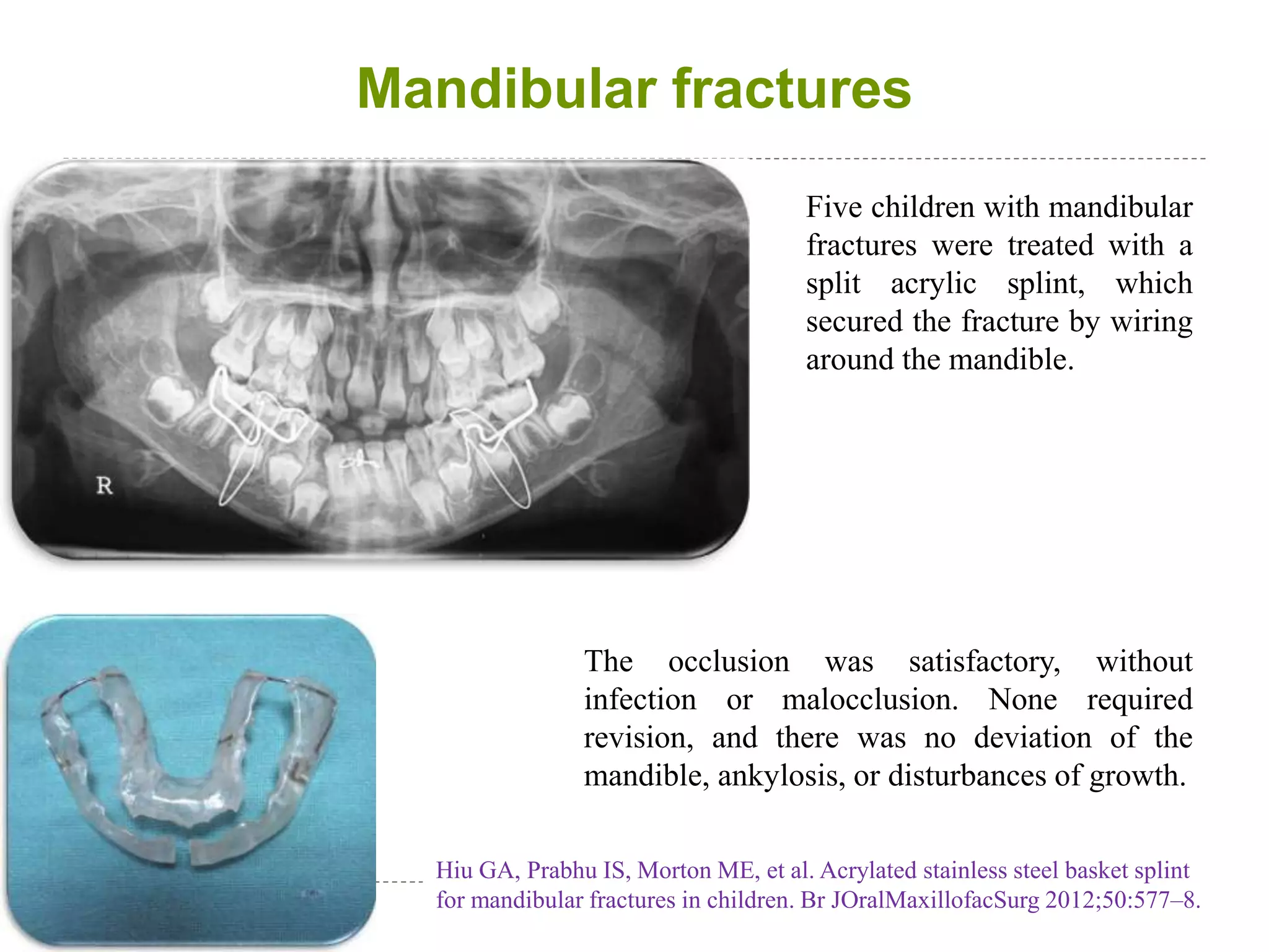 Recent advances in maxillofacial trauma | PPTX