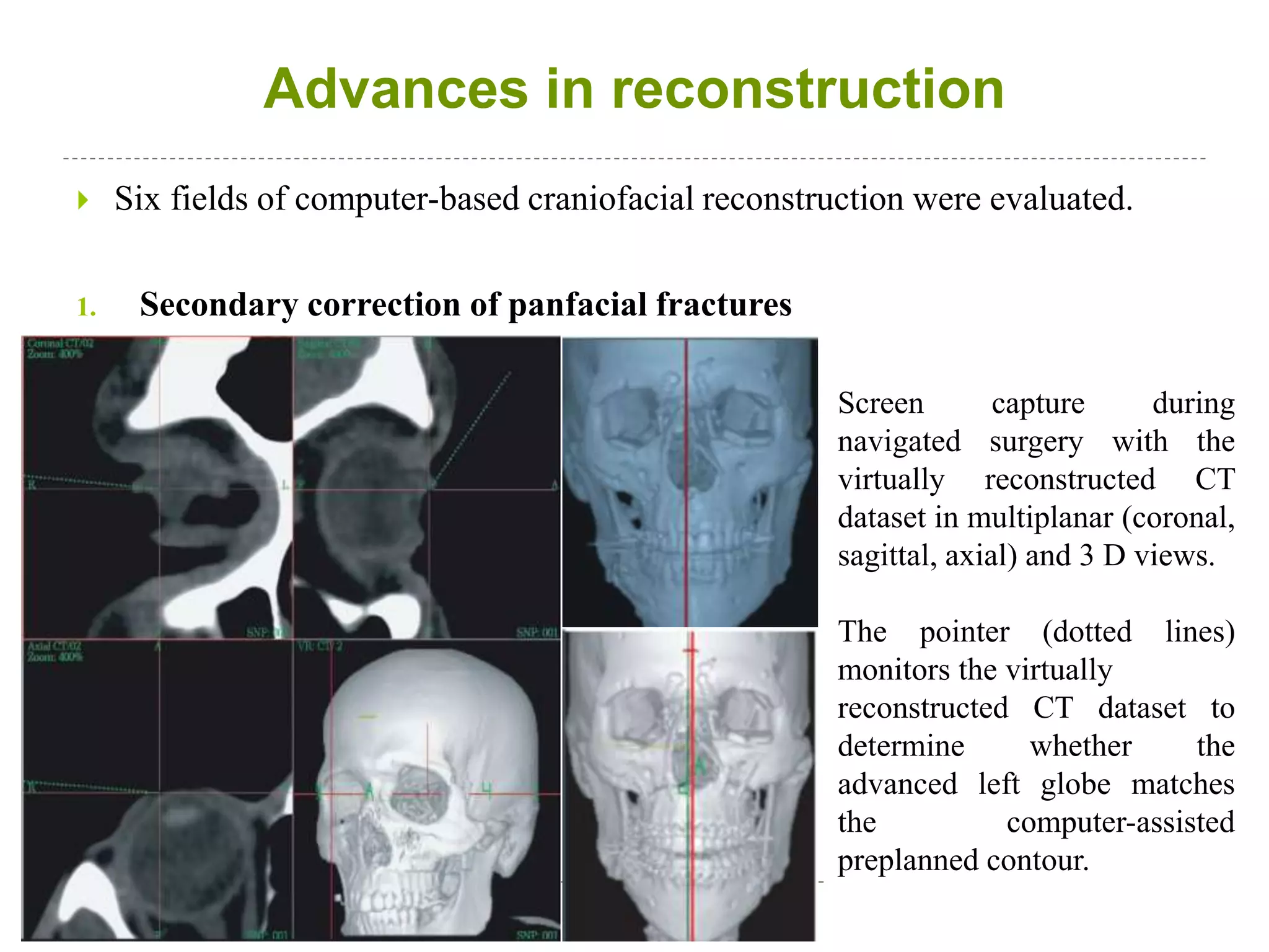 Recent advances in maxillofacial trauma | PPTX