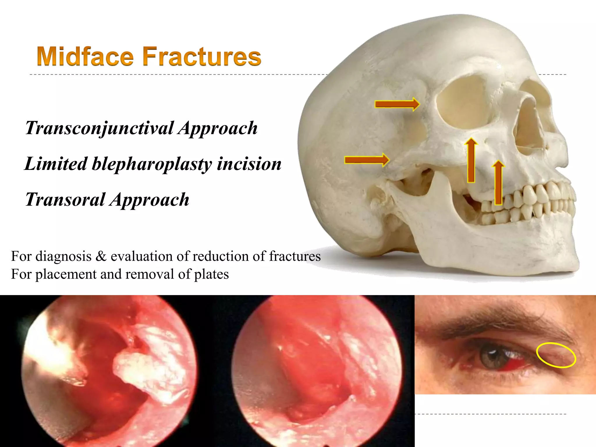 Recent advances in maxillofacial trauma | PPTX
