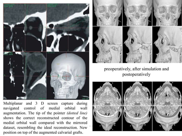 Recent advances in maxillofacial trauma | PPTX
