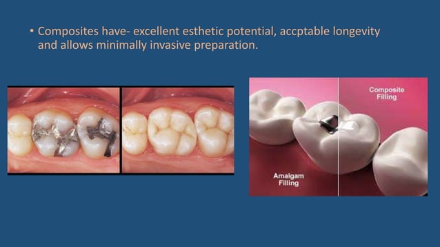 RECENT ADVANCES AND DEVELOPMENTS IN COMPOSITE DENTAL RESTORATIVE ...
