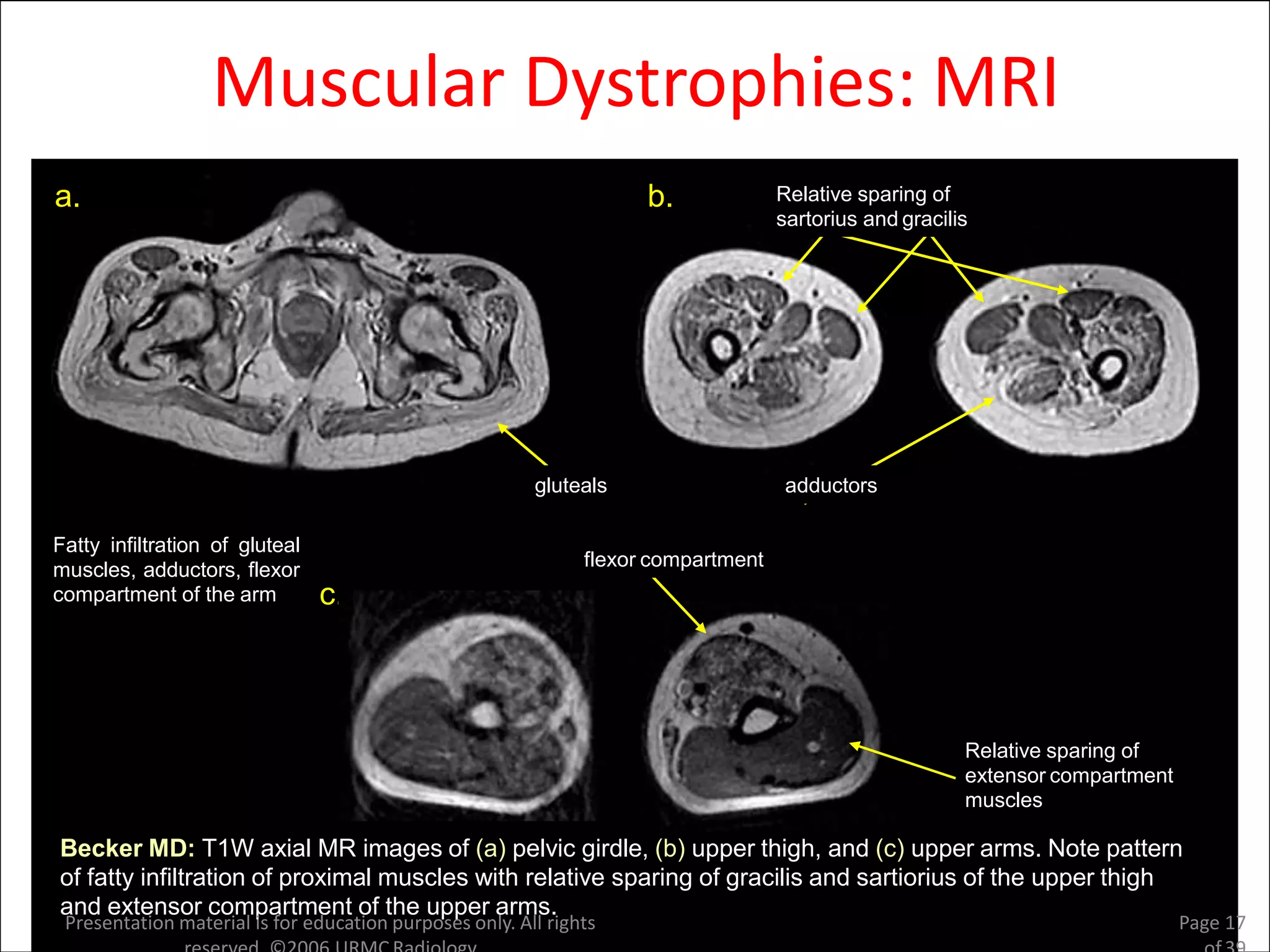Recent advances and evaluation in muscular dystrophies | PPTX