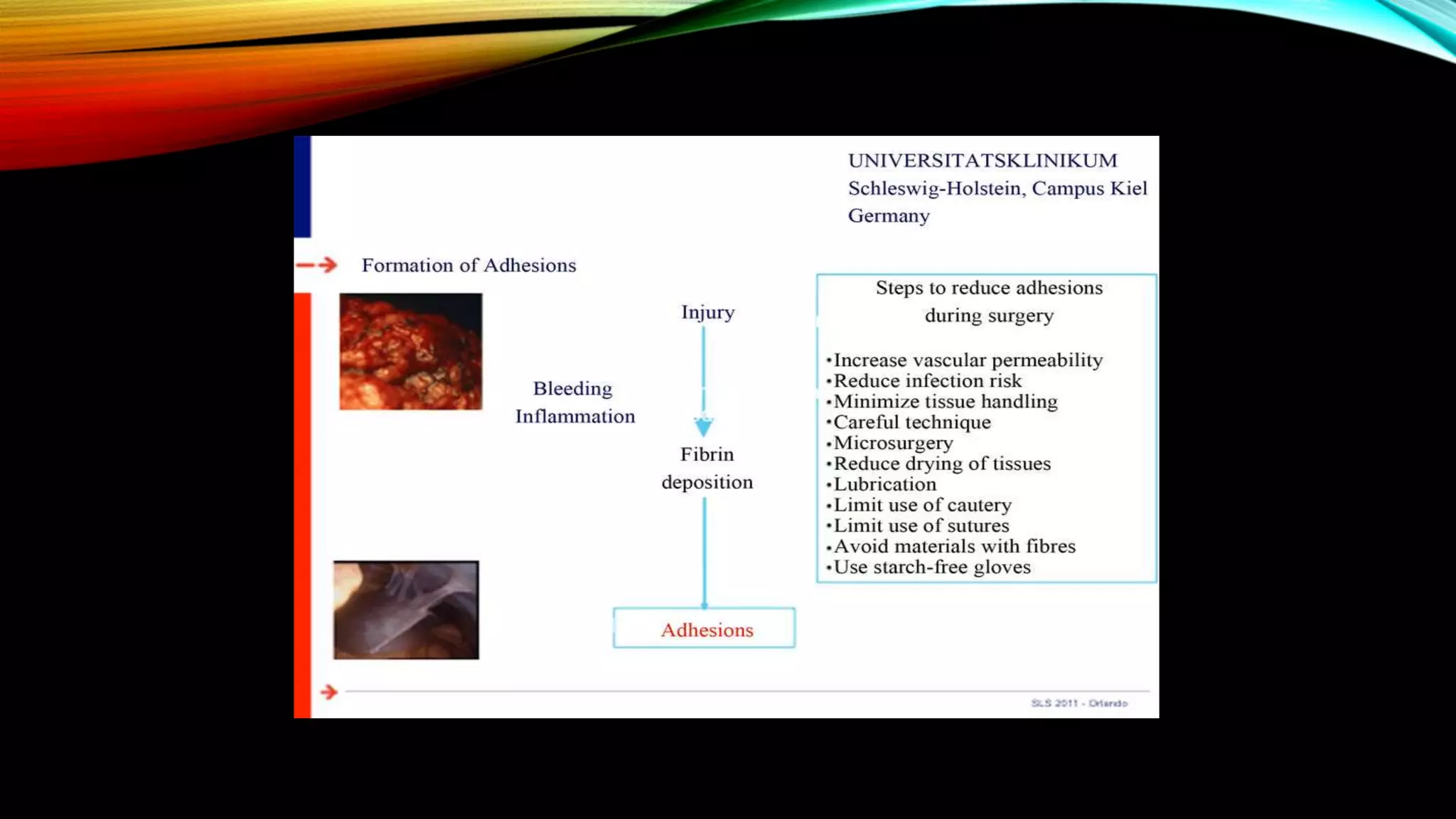 Recent advances in adhesion prevention post laparoscopic surgery.pptx