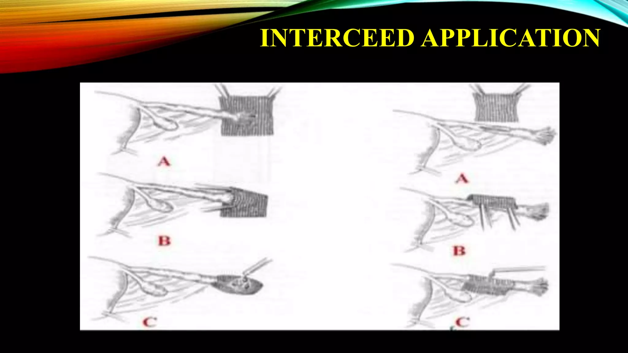 Recent advances in adhesion prevention post laparoscopic surgery.pptx