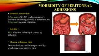 Recent advances in adhesion prevention post laparoscopic surgery.pptx