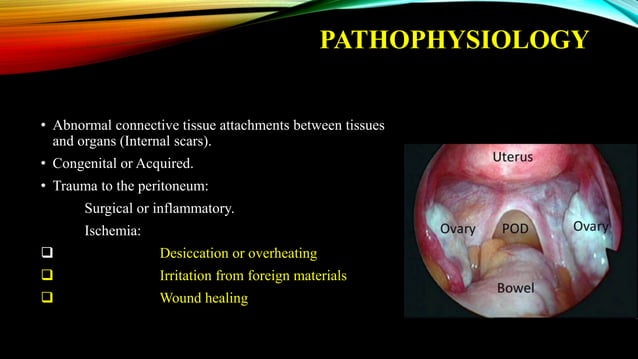 Recent advances in adhesion prevention post laparoscopic surgery.pptx