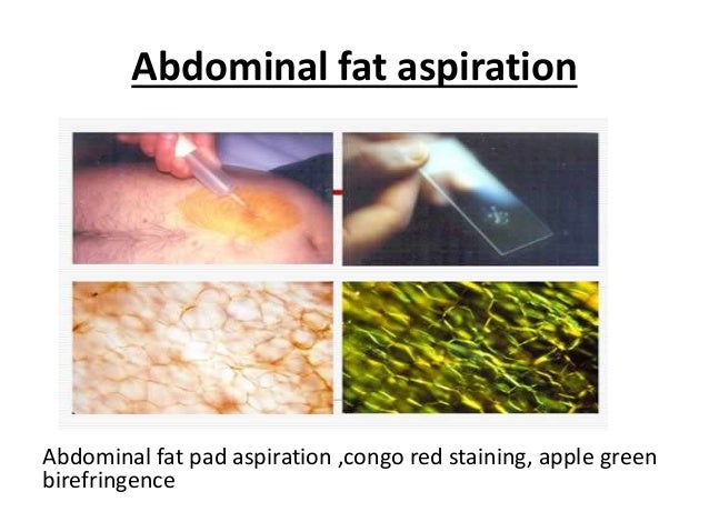 Recent Advances In Amyloidosis