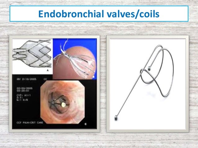 Recent advances in Asthma & COPD by Dr.Tinku Joseph