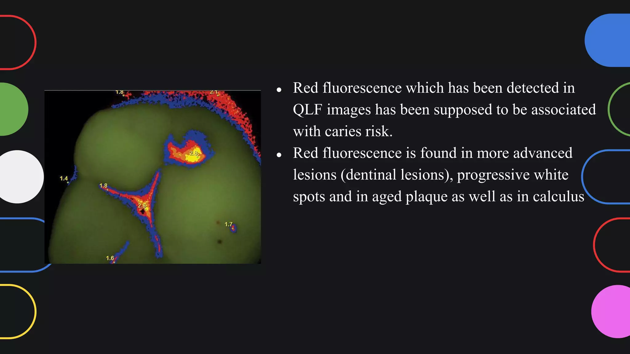 Recent advances in caries diagnosis | PPTX