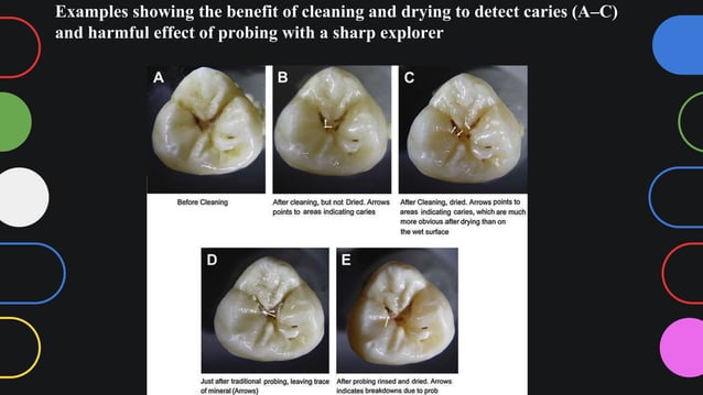 Recent advances in caries diagnosis | PPTX