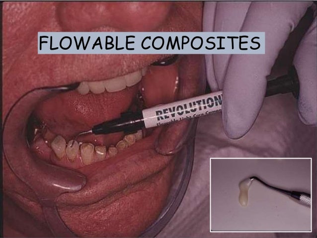 Recent advances in Dental Composites | PPTX